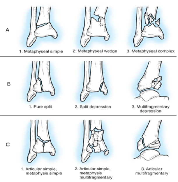 FRACTURAS: FRACTURAS