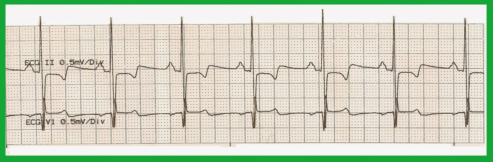 Various Normal Sinus Rhythms