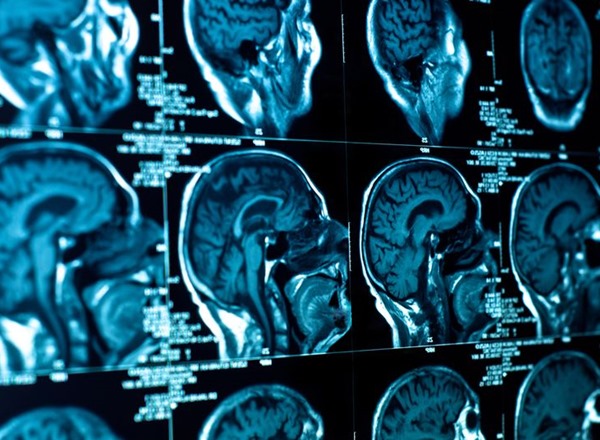 Az agy, a koponya felépítése, agyi CT scan videó (ujmedicina, biologika)