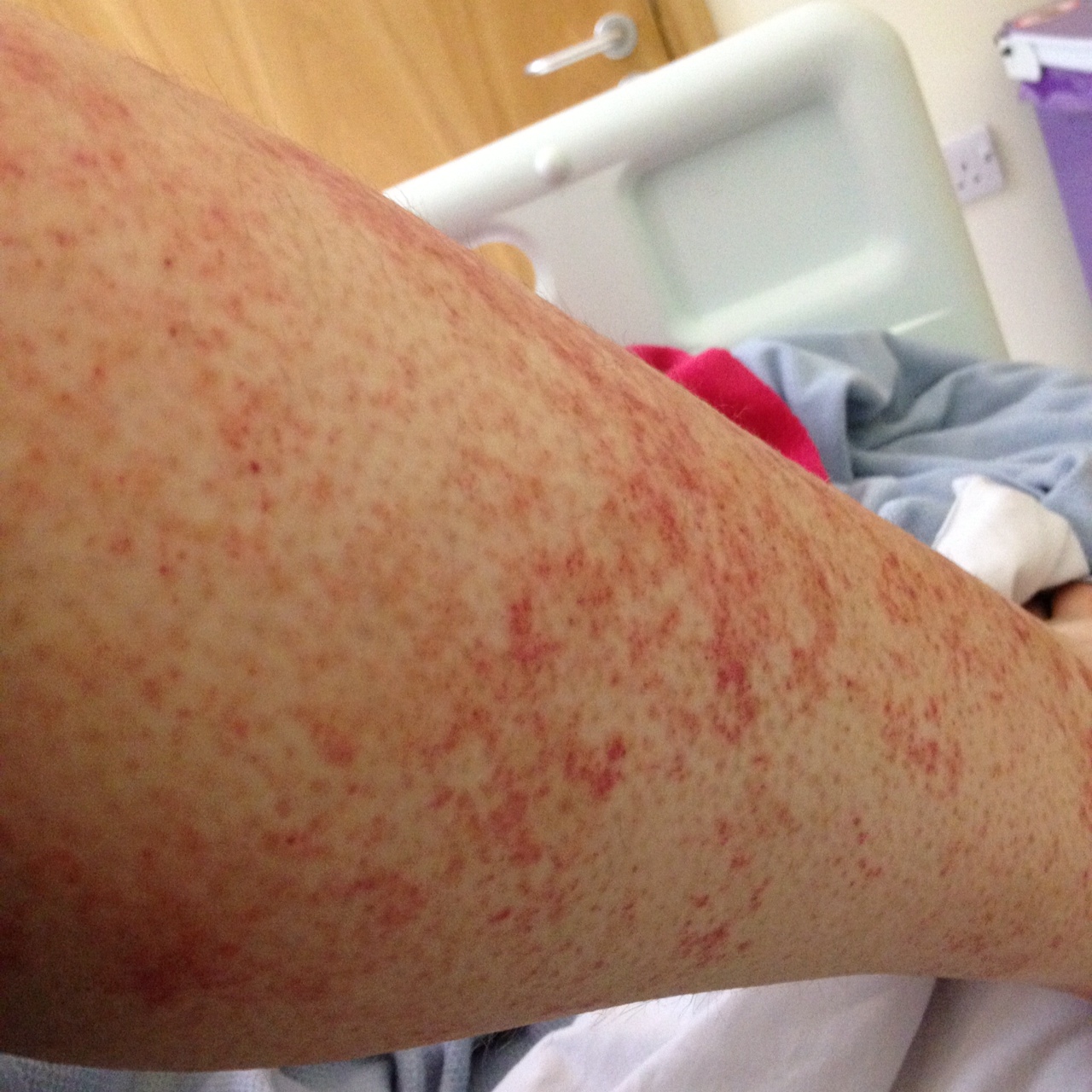 List 93+ Pictures Can You Get A Rash From Liver Problems Stunning