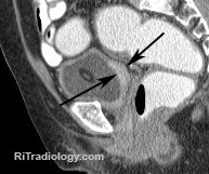 RiT radiology: Focal Urinary Bladder Wall Thickening