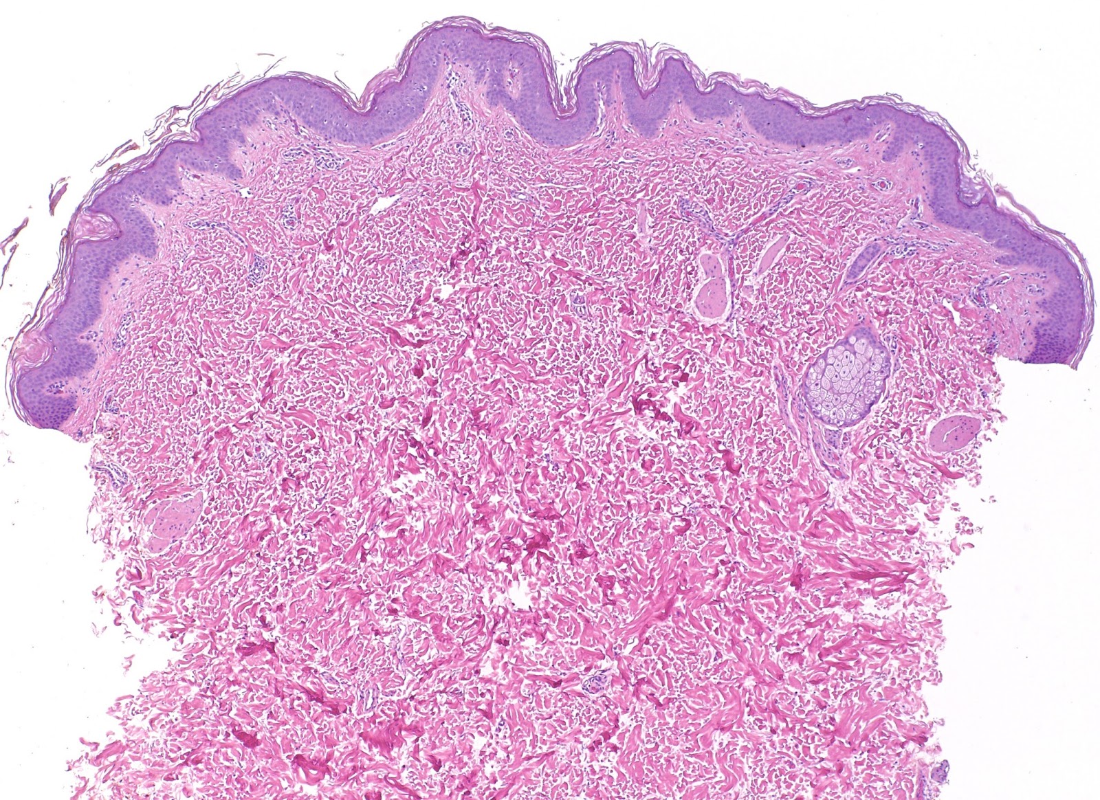 VIRTUAL GRAND ROUNDS IN DERMATOLOGY 2.0: Confluent and Reticulated ...