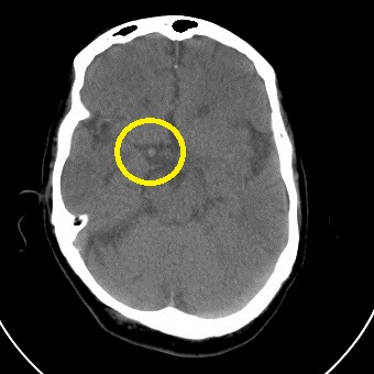 POINT OF VIEW: DX: Acute-hyperacute stroke of the right MCA, M2 territory