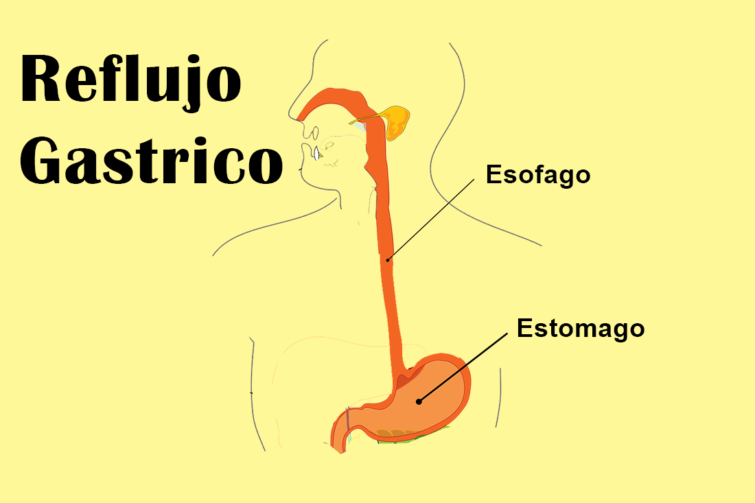 Como curar el reflujo gástrico de forma natural - Explicacion ...