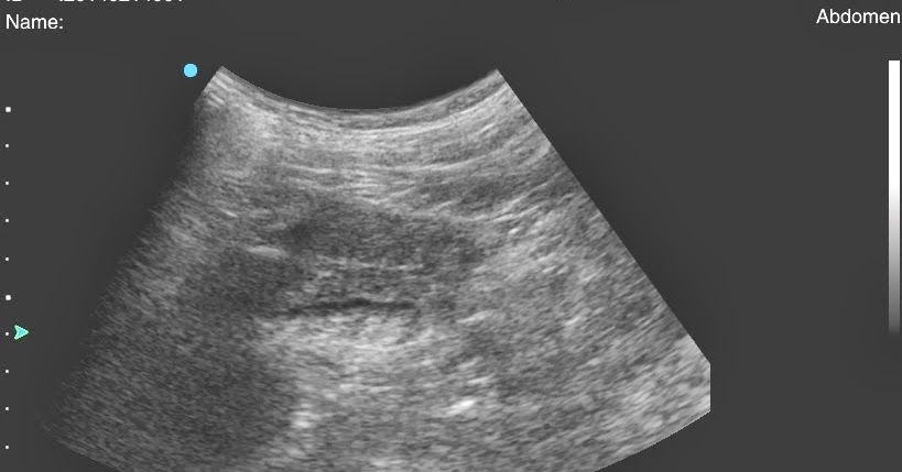 VIETNAMESE MEDIC ULTRASOUND: CASE 239: COLON TUMOR and WALLED-OFF ...