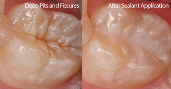 Pit and Fissure Sealant ~ Dr. Bharat Katarmal Dental & Implant Clinic