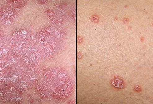 Jamur Di Selangkangan Paha - Homecare24