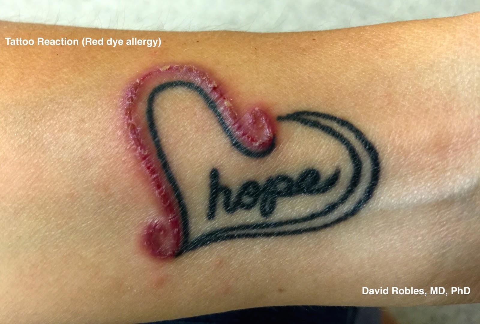 Tattoo Reactions: Allergic Contact Dermatitis By David Robles, MD, PhD