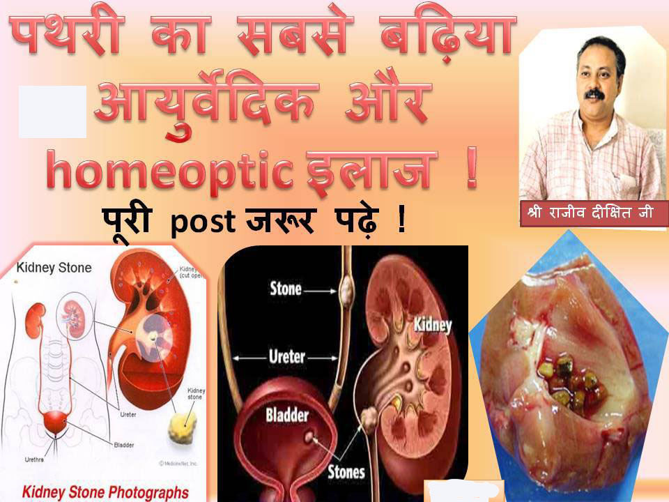 पथरी का आयुर्वेदिक इलाज | ayurvedic free treatment
