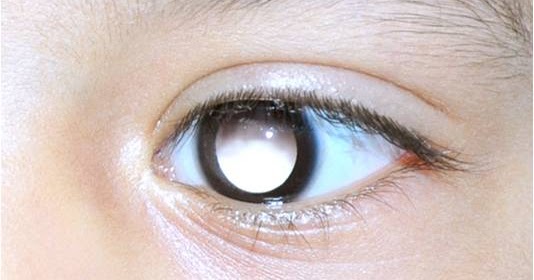 White Spot in Eye – Be Aware! Early detection of childhood eye cancer ...