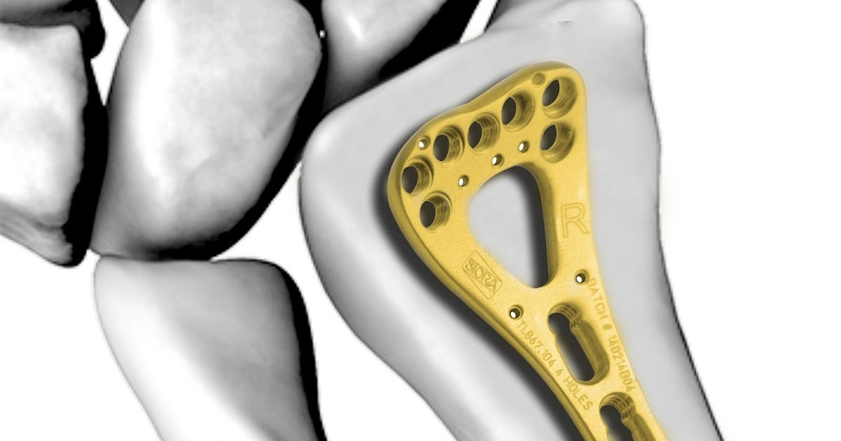 Orthopedic Implants Manufacturer: Adding Gold to Titanium Enhances ...