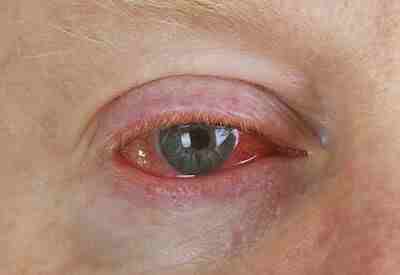 Infective Conjunctivitis (pink Eye): Causes, Treatment Remedies