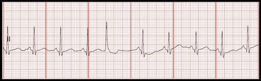 EKG Rhythm Strip Quiz 134