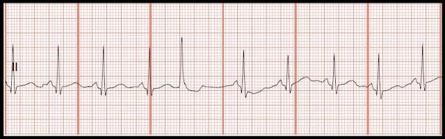 EKG Rhythm Strip Quiz 134