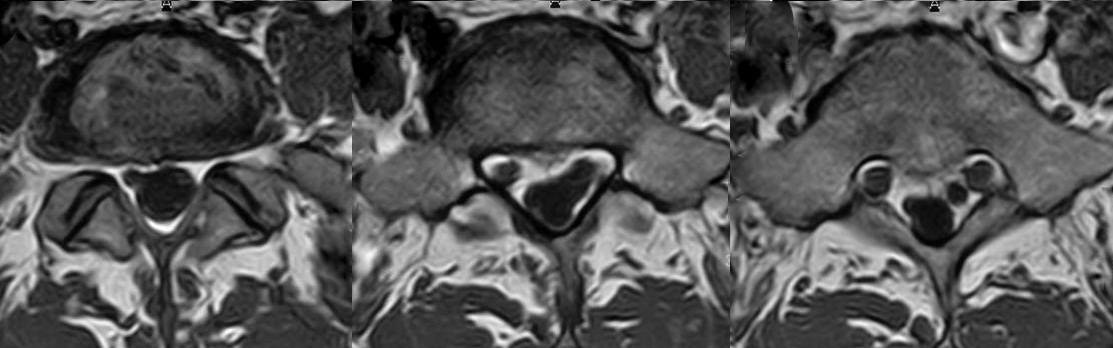 Dr Balaji Anvekar FRCR: Conjoined Nerve Root MRI