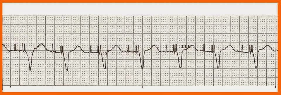Various Dual Paced Rhythms