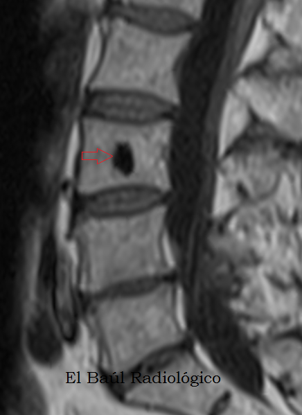 El Baúl Radiológico: ENOSTOSIS: ISLOTE ÓSEO (Bone Island: CT and MRI ...