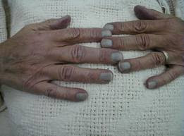 Adicione seu link: O que é cianose