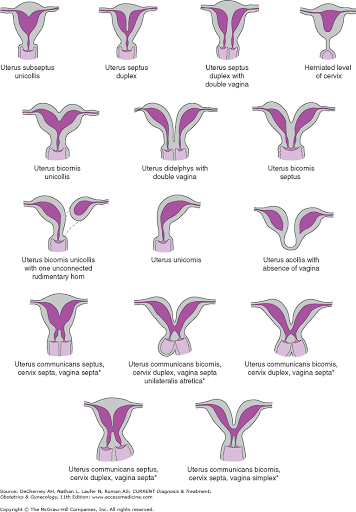 Bicornuate Uterus Treatment