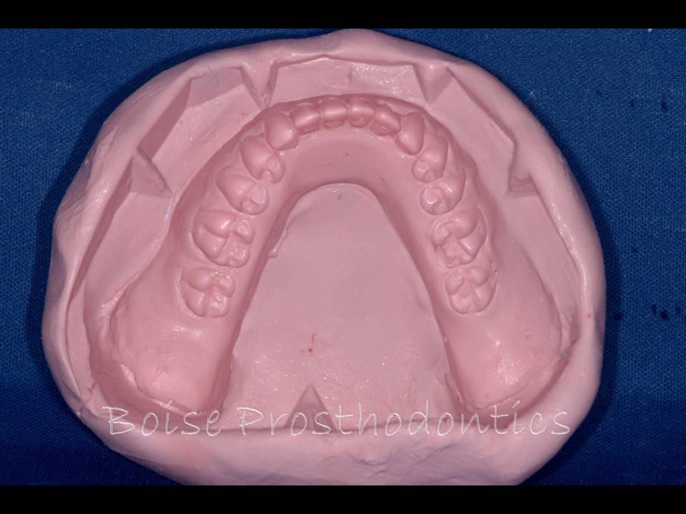 Boise Idaho Prosthodontics: Picture Sequence of Maxillary Complete ...