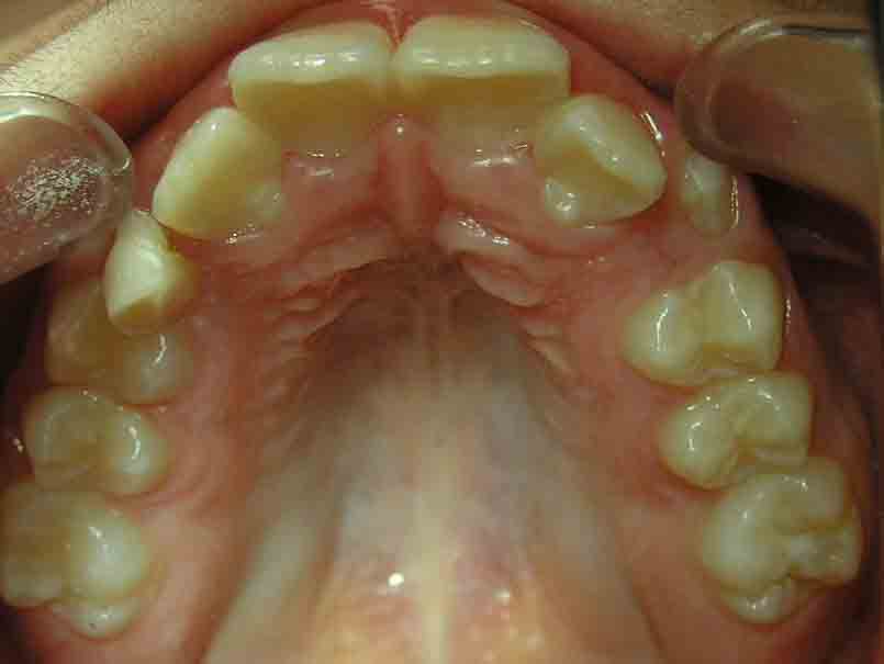 Una Boca para toda la Vida: Respiración nasal: estímulo positivo para ...