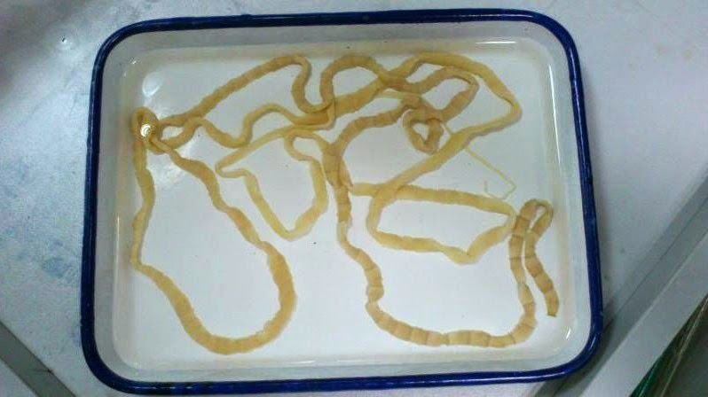 Cacing kerawit Sepanjang Enam Inci Hidup Dalam Otak Kerana Minum Air Sungai