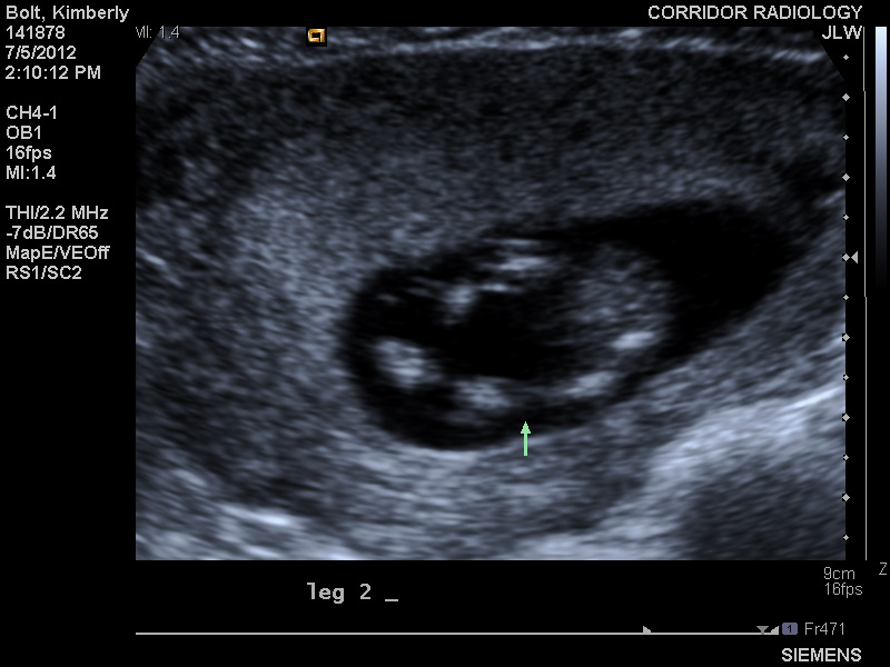1+1=3: 13w1d Ultrasound!