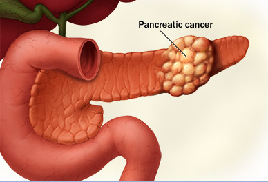 Cancer e Diabetes: Câncer de Peritônio