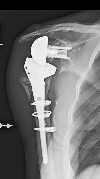 UW Shoulder and Elbow Academy: Reverse total shoulders - failures in ...