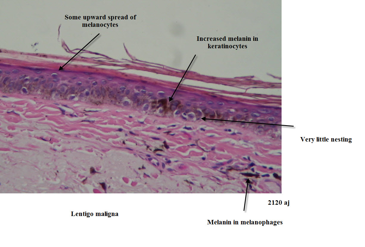 Dermpath Made Simple - Neoplastic: Lentigo Maligna