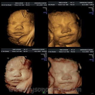 2D 3D 4D 5D HD Live Scan | Sonoworld Malaysia: 5D SCAN