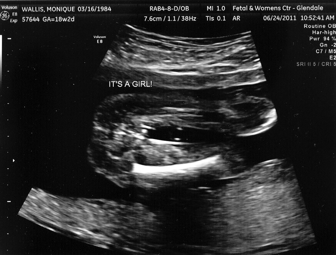 Within Wallis Walls: 18 Week Ultrasound