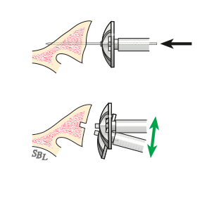 Shoulder Arthritis / Rotator Cuff Tears / Shoulder Pain : Glenoid ...