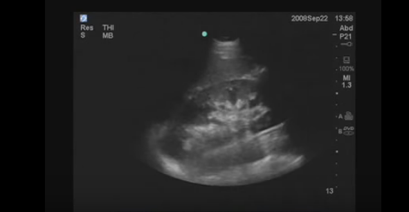 Flanco Esquerdo : Ultrassonografia Renal: visualização do rim e ...