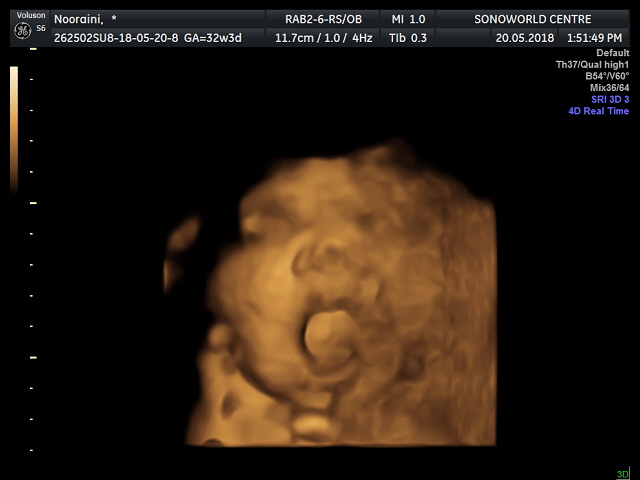 Scan 5D adik baby di Klinik My Family