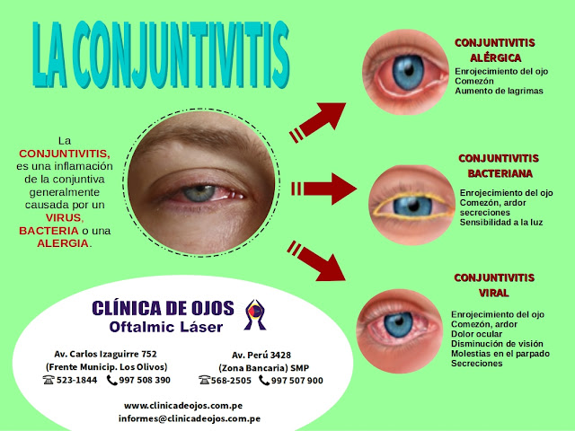 Clínica de Ojos Oftalmic Láser: LA CONJUNTIVITIS