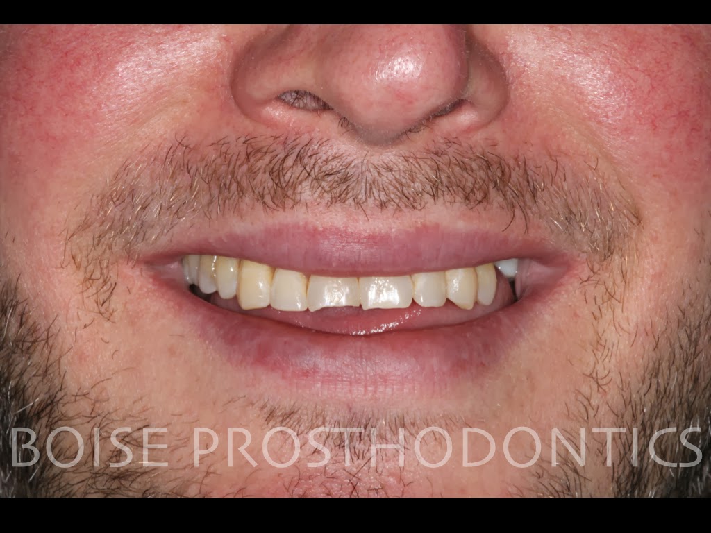 Boise Idaho Prosthodontics: True Immediate Maxillary Complete Denture ...