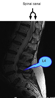 What Causes Facet Joint Hypertrophy With Cyst