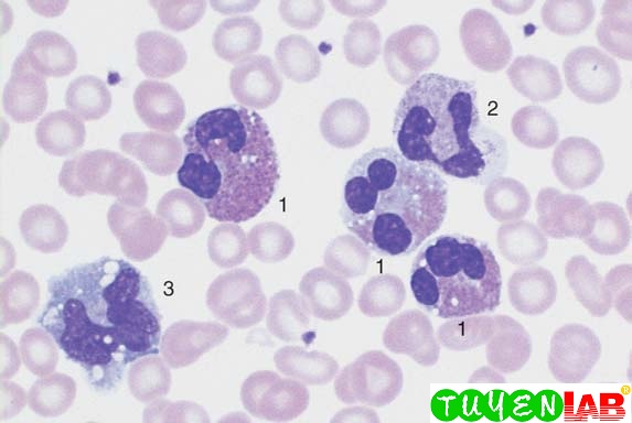 [Haematology] Abnormalities of the White Cell Series | Free Medical Atlas