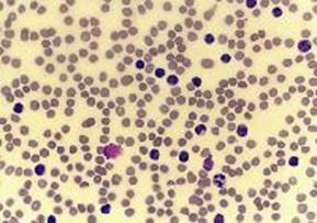 Leukemia Limfositik Kronik (CLL) ~ Informasi Kedokteran Dan Kesehatan