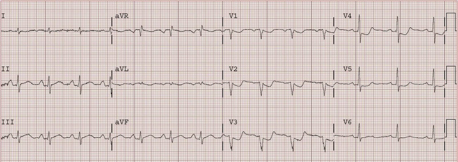Dr. Smith's ECG Blog: Pure (Isolated) Posterior STEMI -- not so rare ...