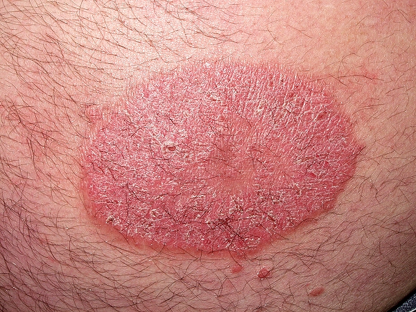 Tipos De Psoriasis y Remedios Naturales Para Curarlas - Psoriasis ...