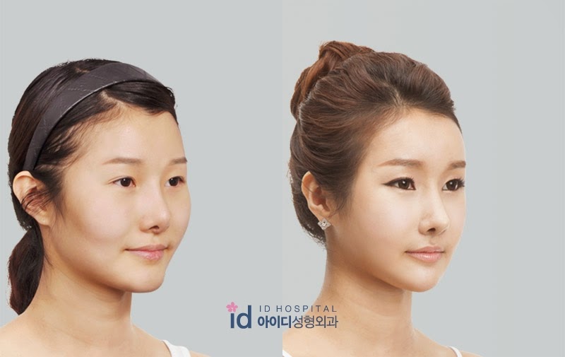 ID Hospital Korea: What is cheekbone reduction surgery? And why do we ...