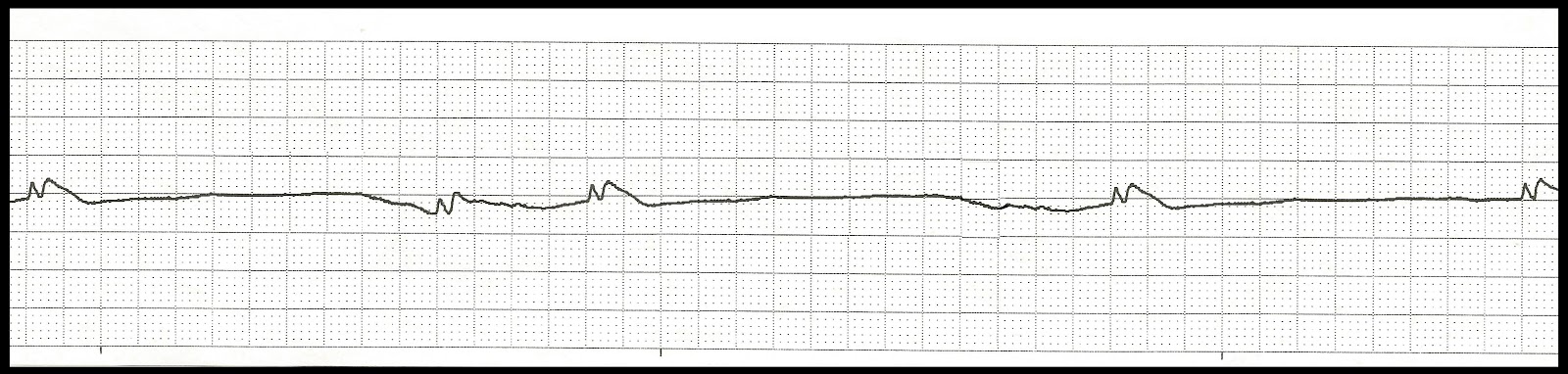 EKG Rhythm Strips 91 Various Agonal Rhythms