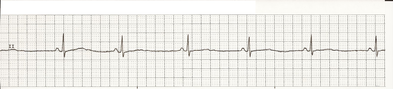 EKG Rhythm Strips 15: Sinus Rhythms
