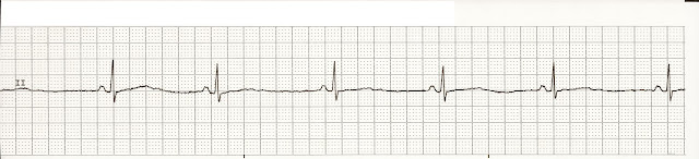 EKG Rhythm Strips 15: Sinus Rhythms