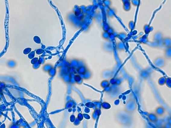 Fun With Microbiology (What's Buggin' You?): Scedosporium prolificans