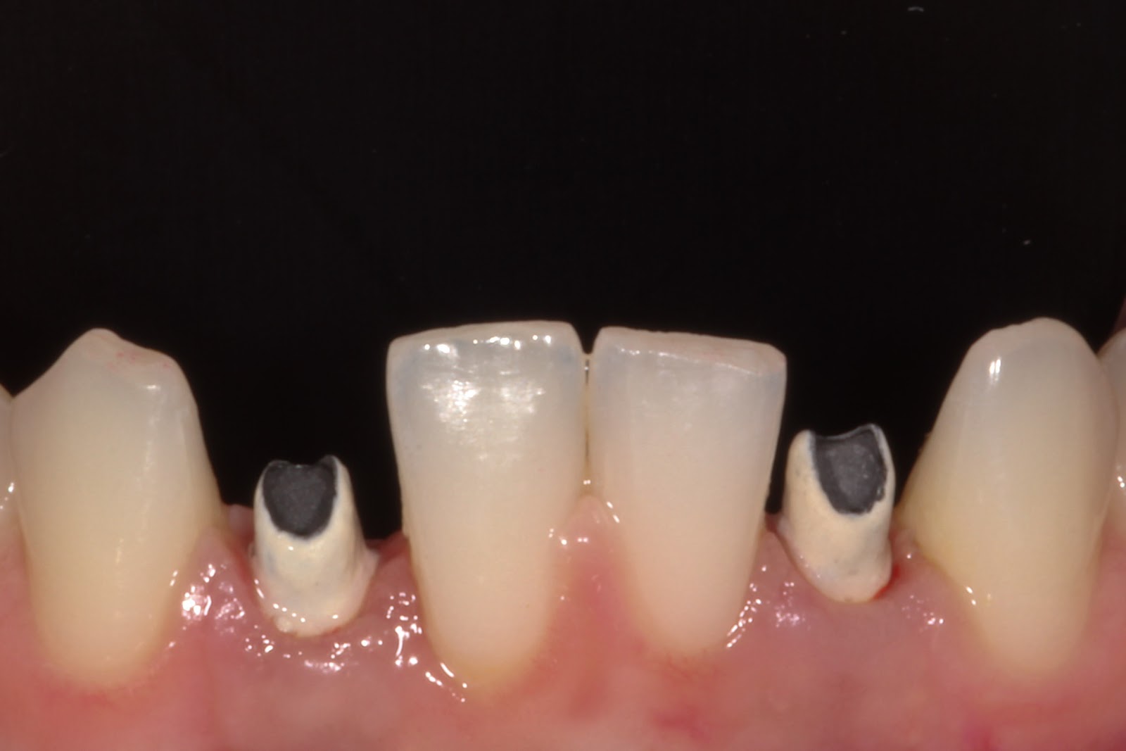 Boise Idaho Prosthodontics: Nobel Active 3 mm Custom Abutment Emax ...