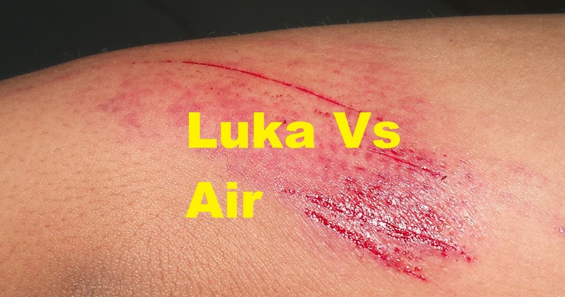 Luka tidak boleh basah ~ akufisio.blogspot