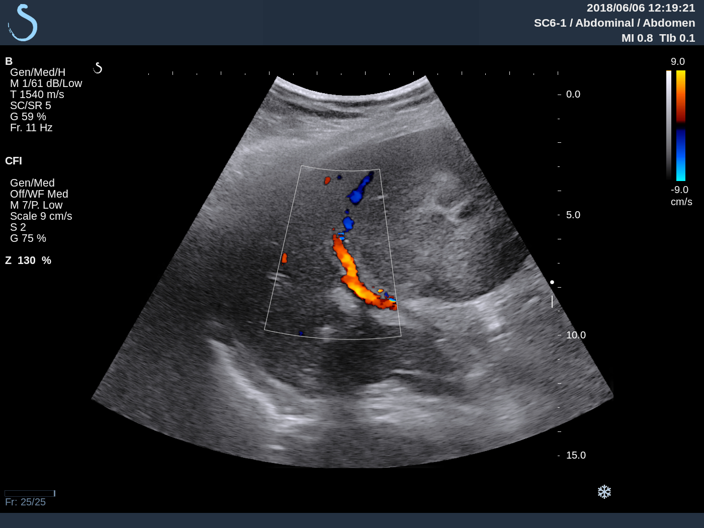 VIETNAMESE MEDIC ULTRASOUND: CASE 498: GALLBLADDER ABSCESS, Dr PHAN ...